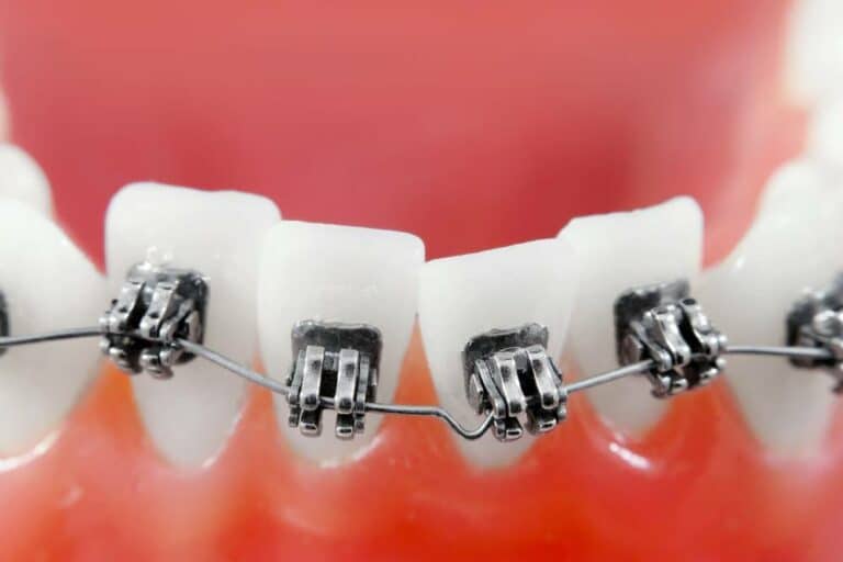 The Different Parts of Braces and What They Do - Orthodontist ...